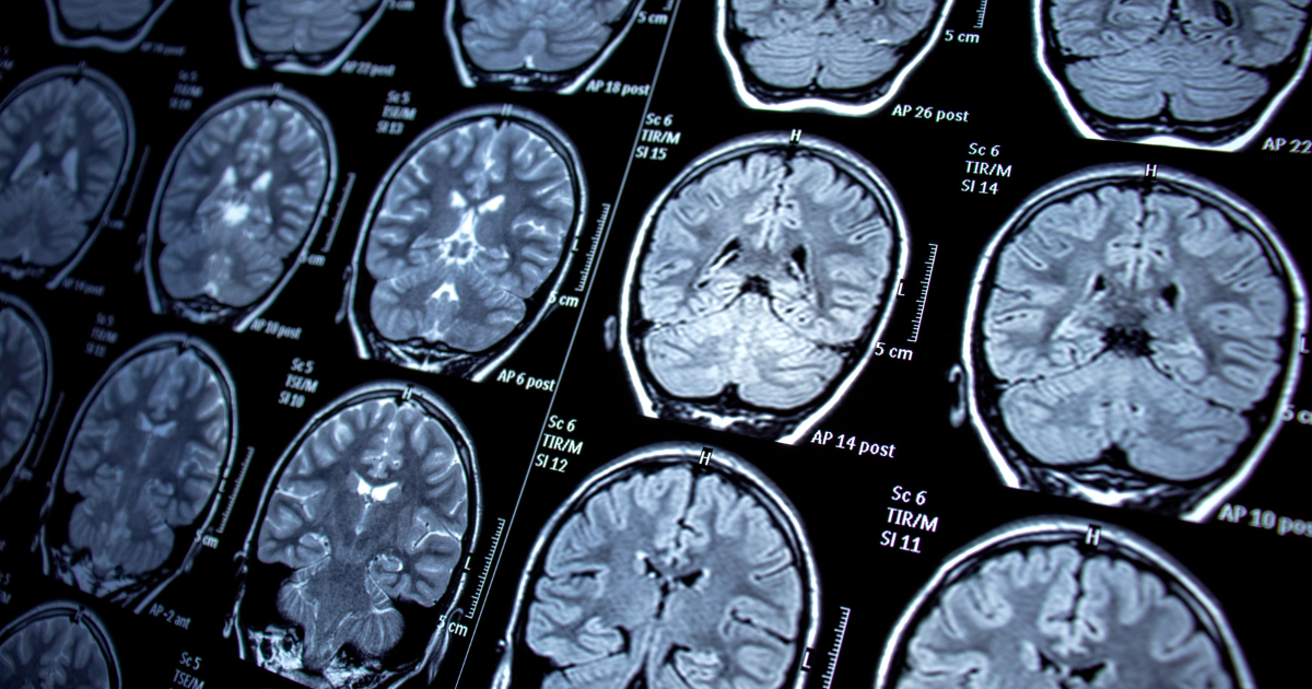 Alcohol Withdrawal Seizures: What Happens in the Brain